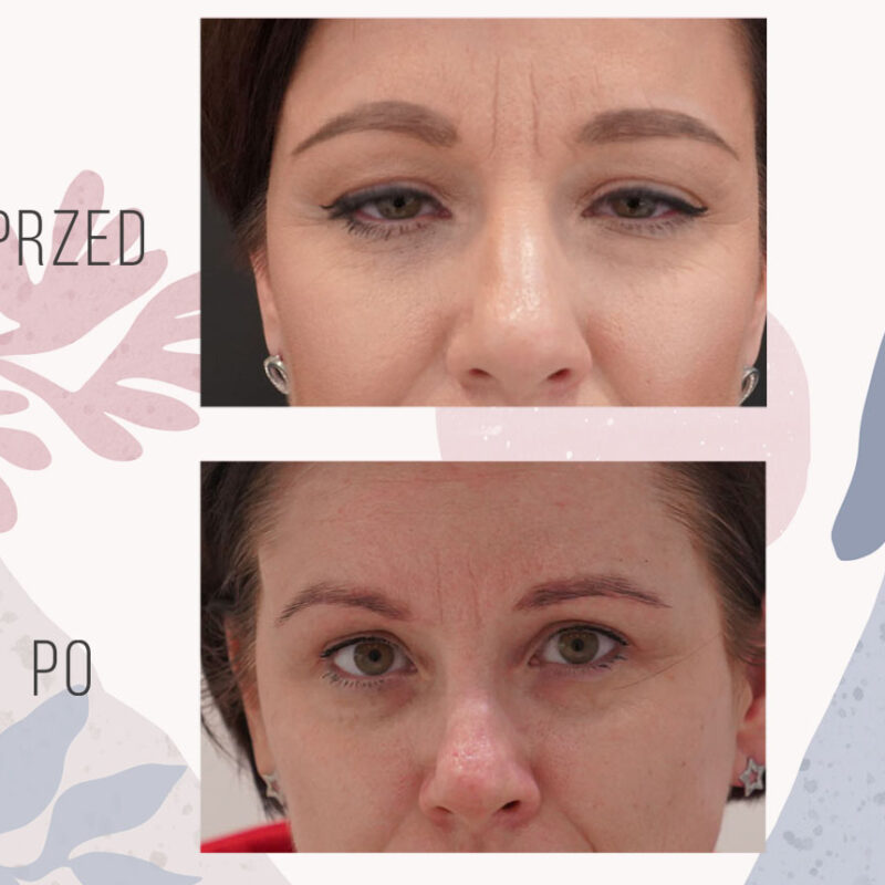 Blefaroplastyka powiek – operacja powiek górnych i dolnych