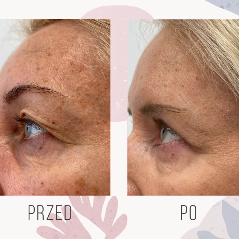 Blefaroplastyka powiek – operacja powiek górnych i dolnych