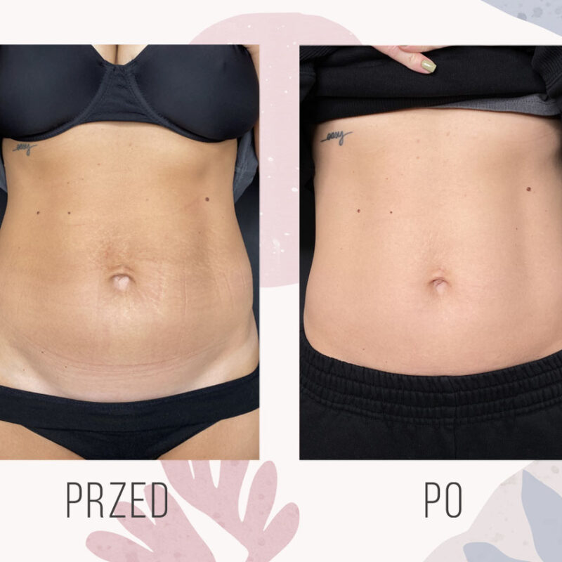 Stymulator tkankowy Sculptra (kwas polimlekowy) → Warszawa