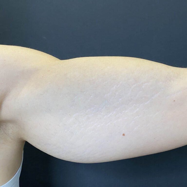 Liposukcja HD 4D, Odsysanie tłuszczu z brzucha → Warszawa