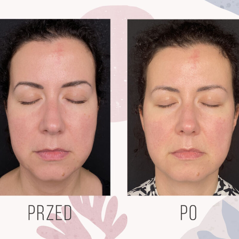 Stymulator tkankowy Sculptra (kwas polimlekowy) → Warszawa