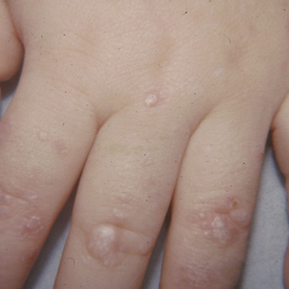 Pemfigoid – czym jest i jak leczyć?