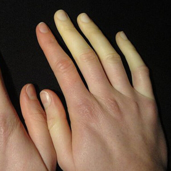 Leczenie objawu Raynauda → Warszawa