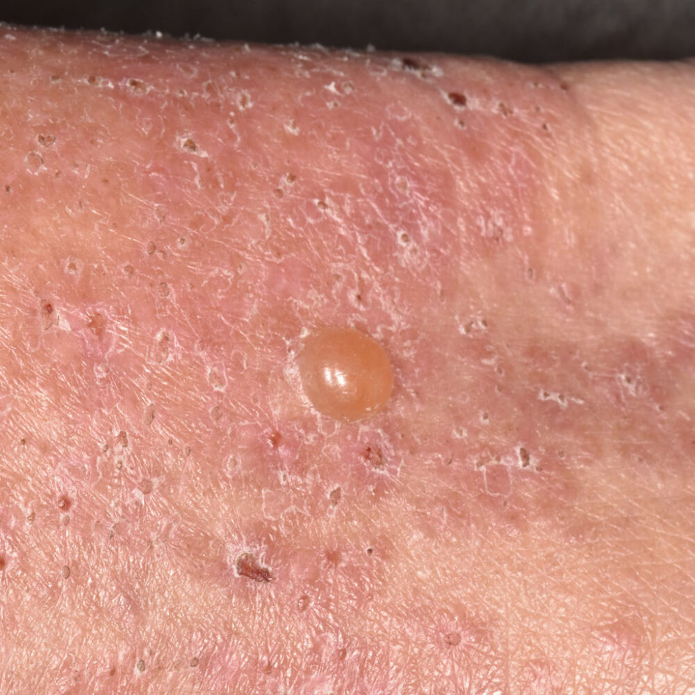 Brodawka łojotokowa – przyczyny, cechy oraz metody leczenia