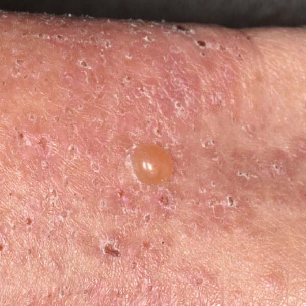 Leczenie Pemfigoidu pęcherzowego → Klinika OT.CO