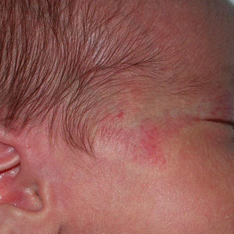 Naczyniaki u dzieci – skąd się biorą i jak je leczyć? » OT.CO Clinic