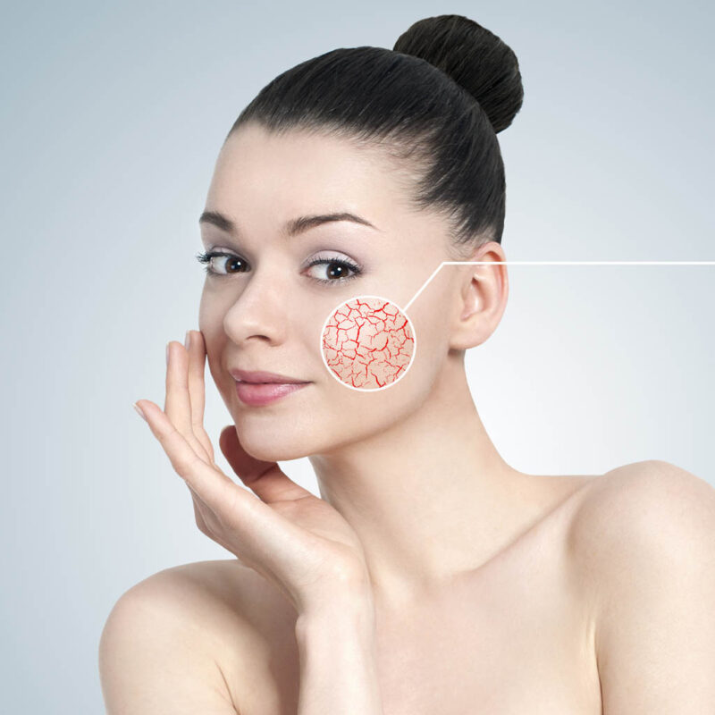Lip Flip Botoks – piękne usta bez wypełnienia