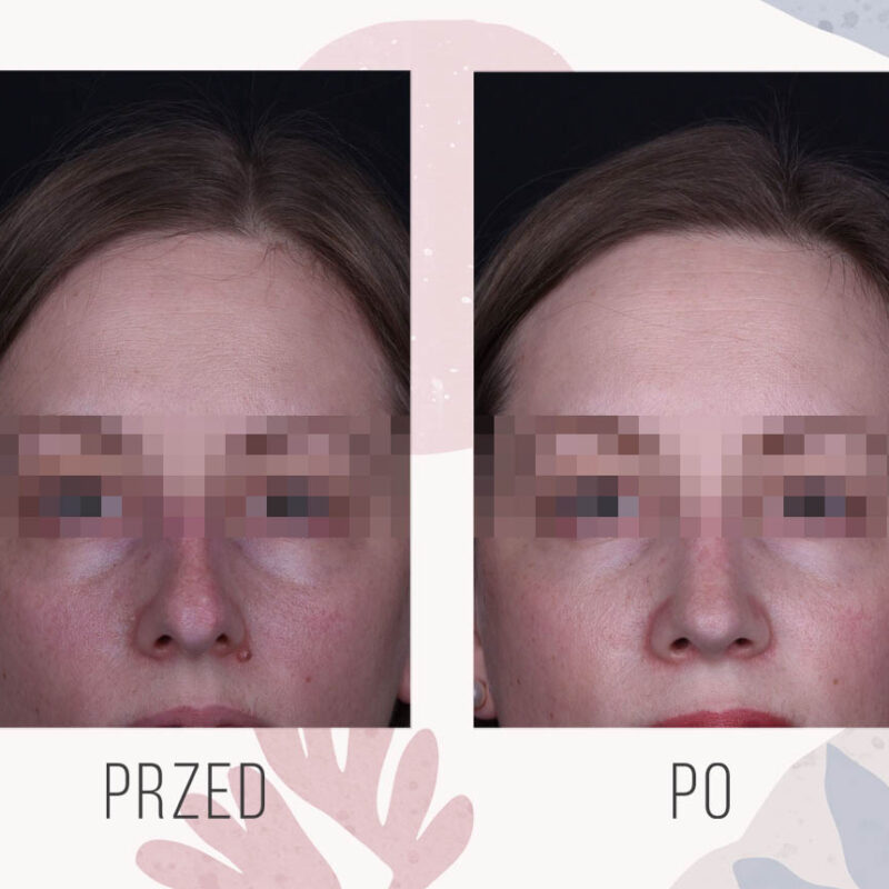 Operacja plastyczna nosa, Korekcja nosa → Warszawa