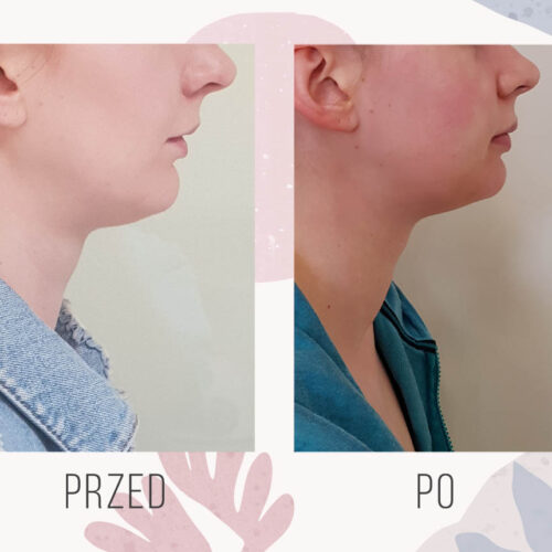 Osteotomia dwuszczękowa, Operacja → Warszawa