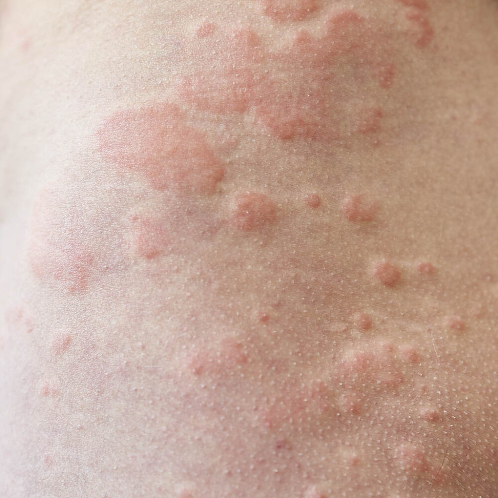 Brodawka łojotokowa – przyczyny, cechy oraz metody leczenia