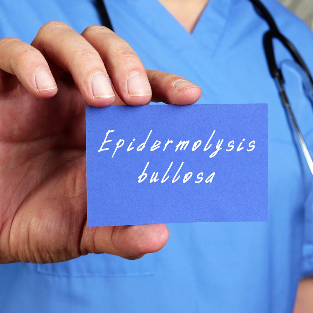 Objaw Raynauda - czym jest i jak leczyć?