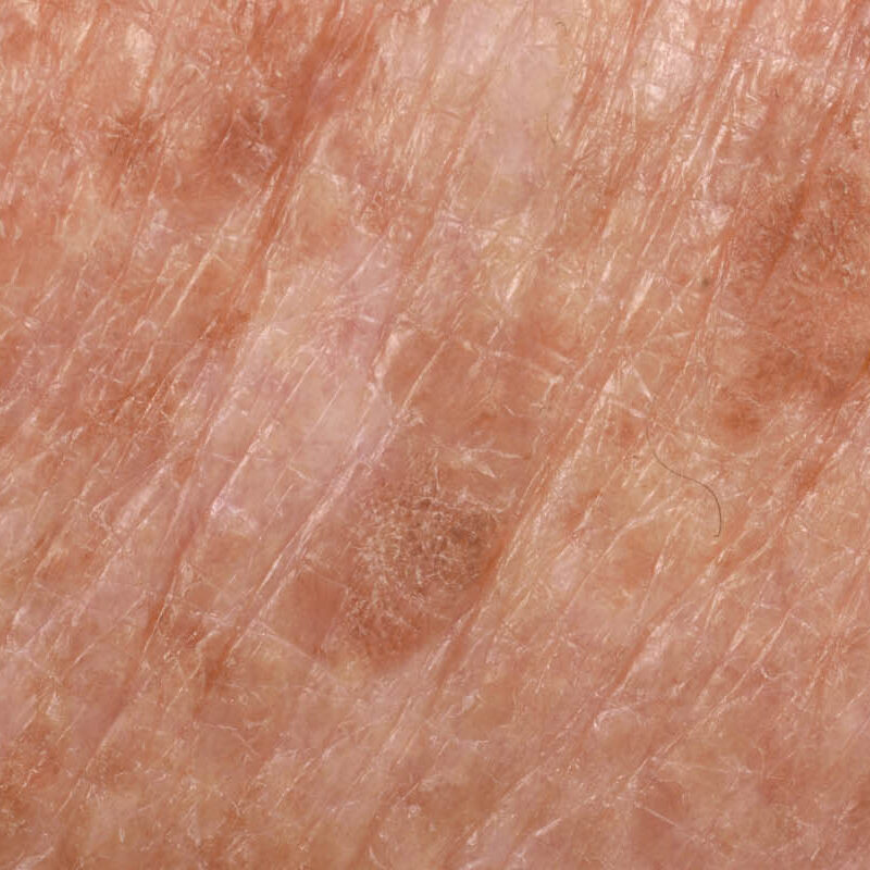 Ciemne plamy na skórze – co je powoduje i jak się pozbyć?