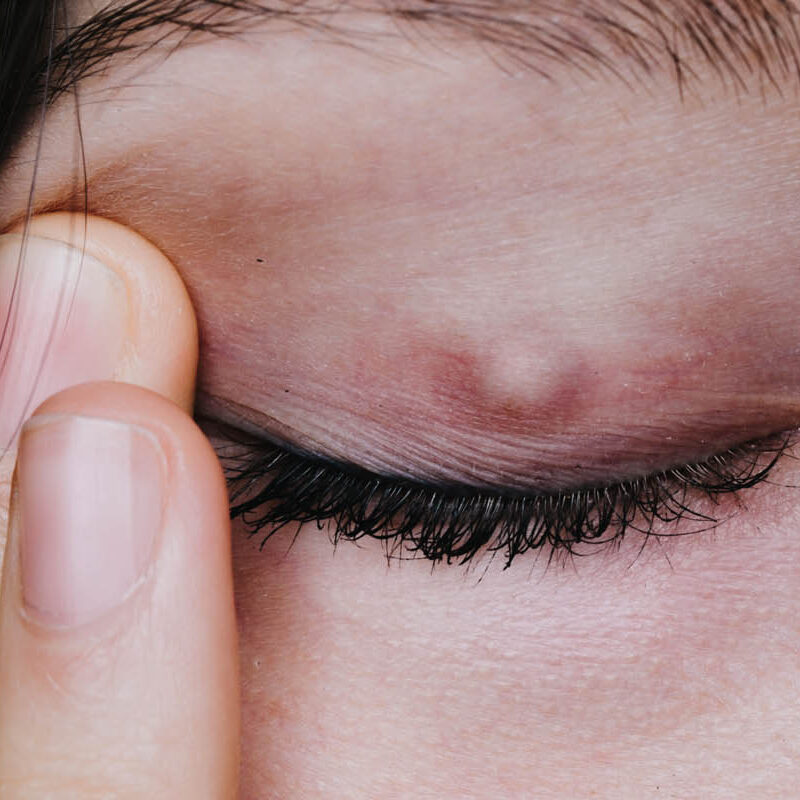 Kaszak na powiece – czy jest groźny i jak go usunąć?
